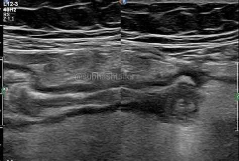 Sono Digest Appendicitis With Perforation At Tip