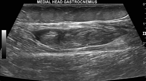 Gastrocnemius Artery Ultrasound