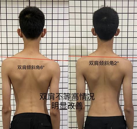 浙江康复医院：了解青少年脊柱侧弯，及早发现治疗 大众康养网