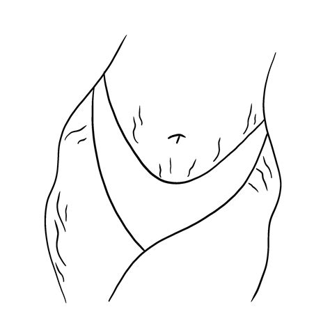 Stretch Marks Line Art Artofit