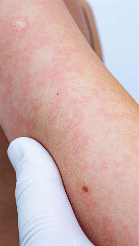 熱痱原因！生熱痱特徵、熱痱幾耐好及處理方法 Elle Hk