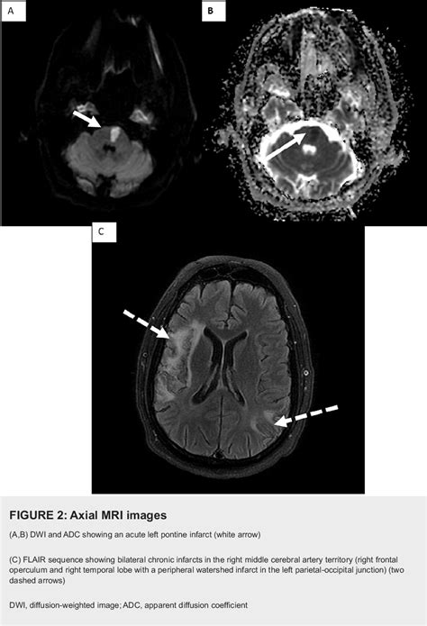 [pdf] Infarcts Of A Cardioembolic Source Mimicking Lacunar Infarcts Case Series With Clinical