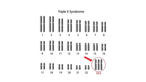 Triple X Syndrome Patient