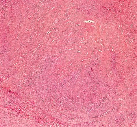Uterine Leiomyoma Libre Pathology