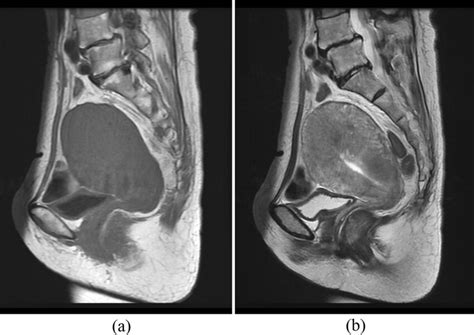 Magnetic Resonance Imaging Demonstrated An Enlarged Uterus With Download Scientific Diagram