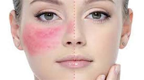 Piel Gruesa Roja Y Con Granos Qué Es La Rosácea Y Cómo Combatirla