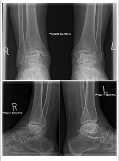 Figure 1 From Development And Implantation Of A Universal Talar