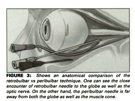 Peribulbar Injection