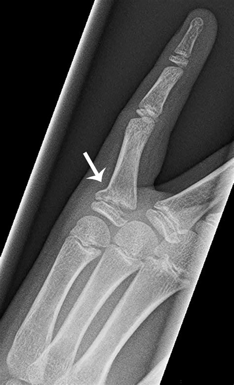 Proximal Phalanx Fracture Splint