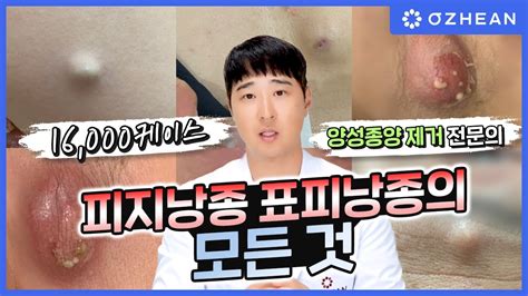 고름폭탄 피지낭종 표피낭종의 모든 것 피부에 생긴 고름 종기 혹 Youtube