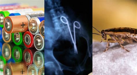 The Weirdest Things Ever Found Inside The Human Body