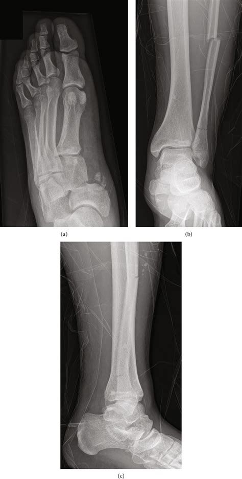 Calcaneocuboid Dislocation