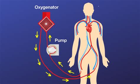 Scotblood What Are Ecmo Machines And How Do They Save Lives