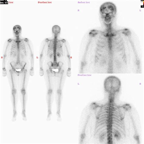 99mtc Methylene Diphosphonate Planar Bone Scan Reveal Asymmetrical