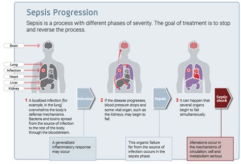 Treatments Sepsis One