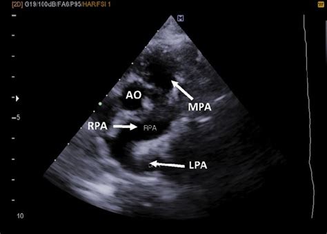 Echocardiography Showing The Abnormal Origin Of Lpa From Rpa Mpa Main Download Scientific