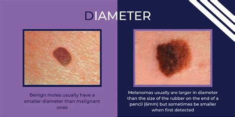 Know Your Mole A B C D And E Self Check Guide Epsom Skin Clinic