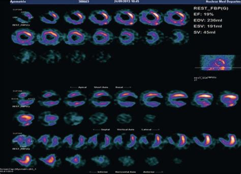 Spect Single Photon Emission Computed Tomography Download Scientific Diagram
