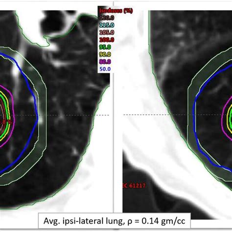 Differential Dose Volume Histogram DDVH A And Difference In Download Scientific Diagram