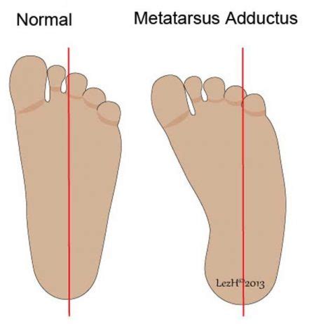 Pigeon Toes Intoeing The Foot And Ankle Clinic