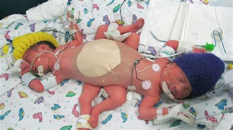 Can Triplets Be Conjoined At Dale Mack Blog