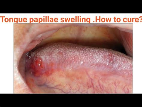 Enlarged Tongue Papillae Bumps