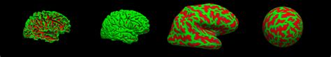 Freesurfer Laboratories For Computational Neuroimaging