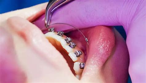 Traditional Braces In Arnold Mo Orthodontics