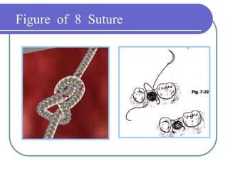 Sutures And Suturing Technique Pptx