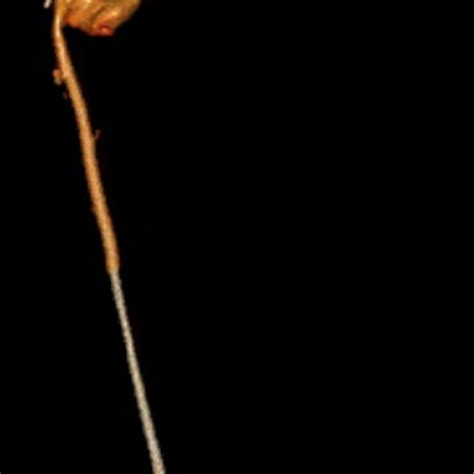 Cta With Vascular Reconstruction Further Revealing Pseudoaneurysm At