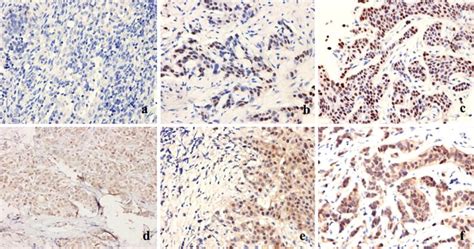 Foxa1 Expression In Er Positive Breast Cancer Patients Before Nac Can