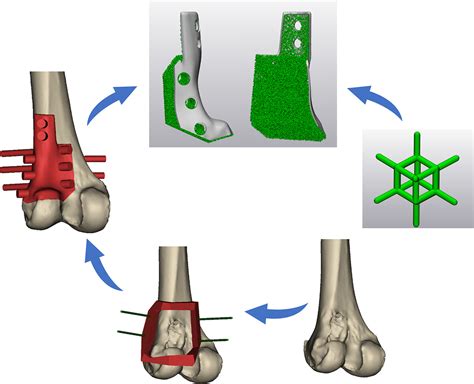3d‐printed Personalized Lattice Implant As An Innovative Strategy To Reconstruct Geographic