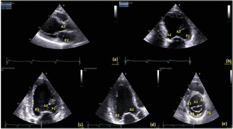 Figure 4 From Echocardiographic Quantification Of Mitral Apparatus