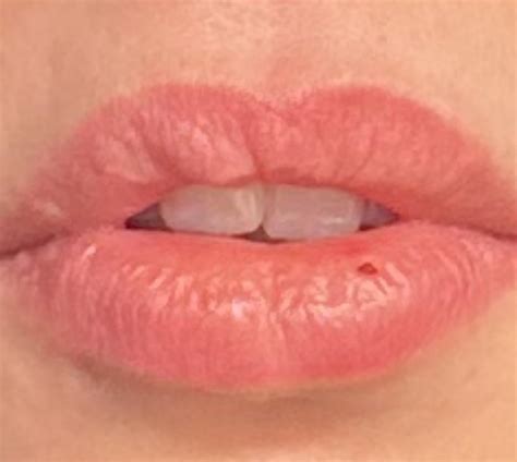 Does Anyone Know Why My Lips Look Like This Warts Please Help R