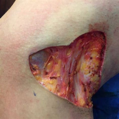 Resection Of Skin And Subcutaneous Tissue Compression Dressings Were