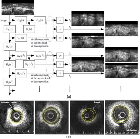Automatic Ivus Contour Detection A Fast Iterative 2d Discrete