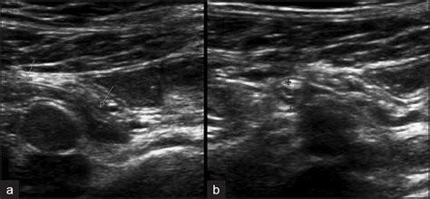 Imaging Acute Appendicitis State Of The Art Journal Of Clinical Imaging Science