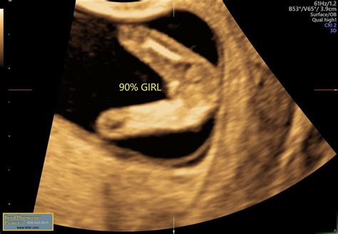 11 Week Ultrasound Pictures Gender