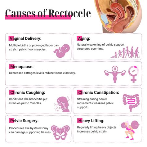 Rectocele Grade 1 Rectocèle Photos Vxafc