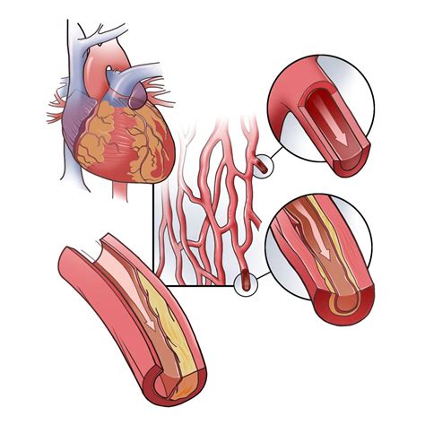 관상동맥우회수술 시술수술안내 일반인정보 심장병원 서울아산병원