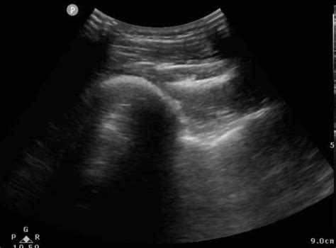 Us Case Of The Month Sonography Of Shoulders — Taming The Sru