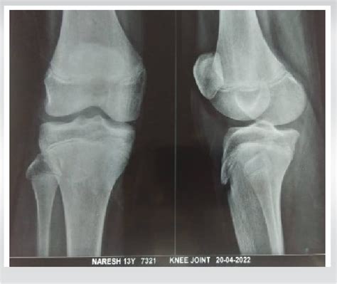 Figure 1 From Synovial Hemangioma Presenting As Anterior Knee Pain A