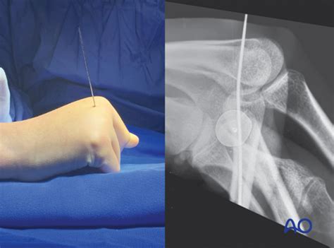 Reduction With Or Without Joint Transfixation For Dislocation Of The