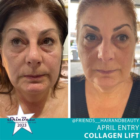Collagen Lift Before And After Artofit