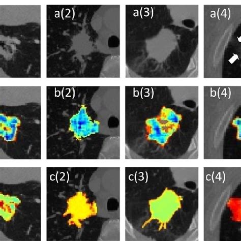 Pdf Automatic Lung Nodule Segmentation And Intra Nodular