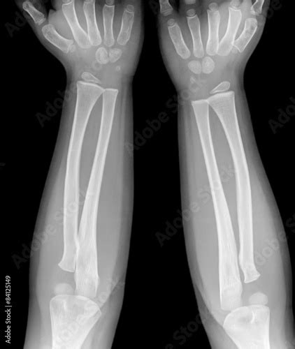 Normal Pediatric Forearm X Ray My Xxx Hot Girl