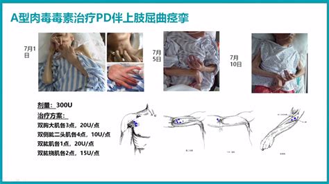【学术报告整理】帕金森病伴肌张力障碍识别及治疗——大连医科大学附属第一医院功能神经中心李涛、梁战华教授分享 脑医汇