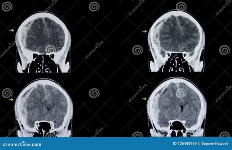 Emorragia Subaracnoidea Del Cervello Immagine Stock Immagine Di