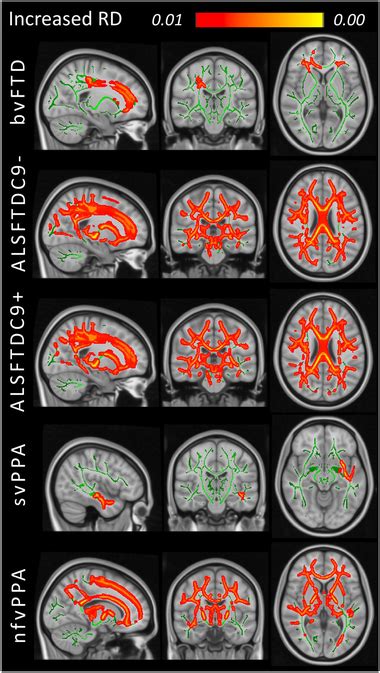 Increased Radial Diffusivity Rd At Group Level In Patients With
