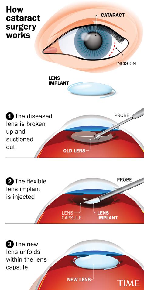What To Expect At Cataract Surgery Time